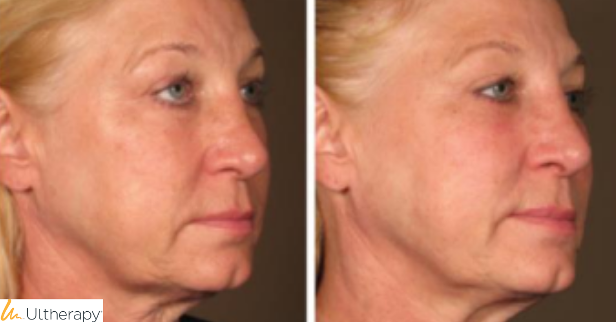 Non-surgical facelifts using Ultherapy - The Body Work Clinic