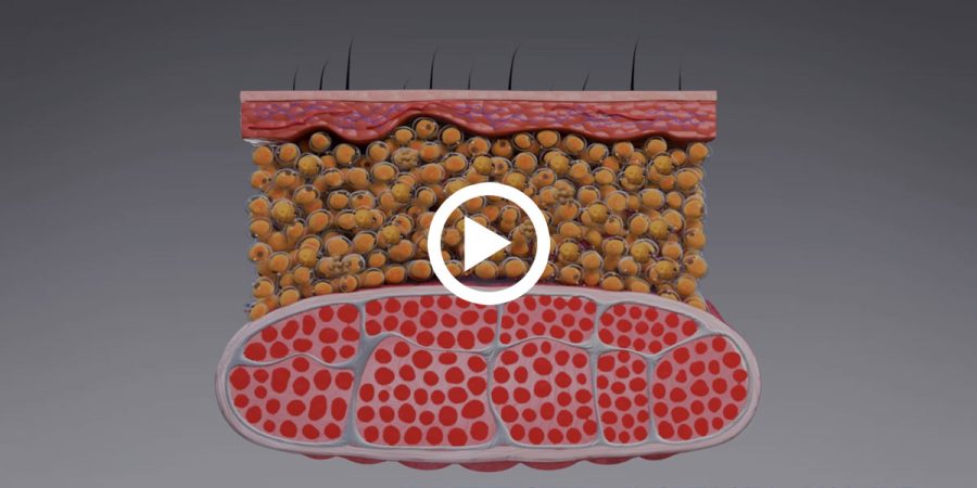 Body Contouring - Detailed Explanation - The Body Work Clinic