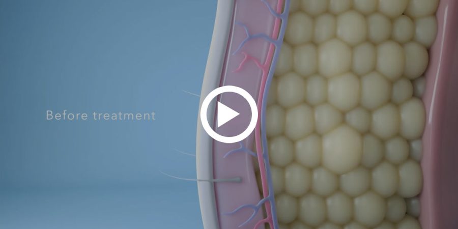 Body Contouring - Detailed Explanation - The Body Work Clinic